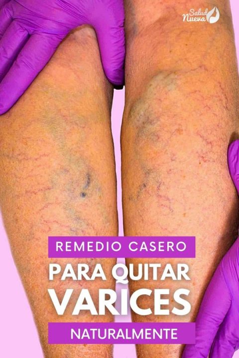 Cómo Eliminar Las Varices De Manera Natural Salud Nueva