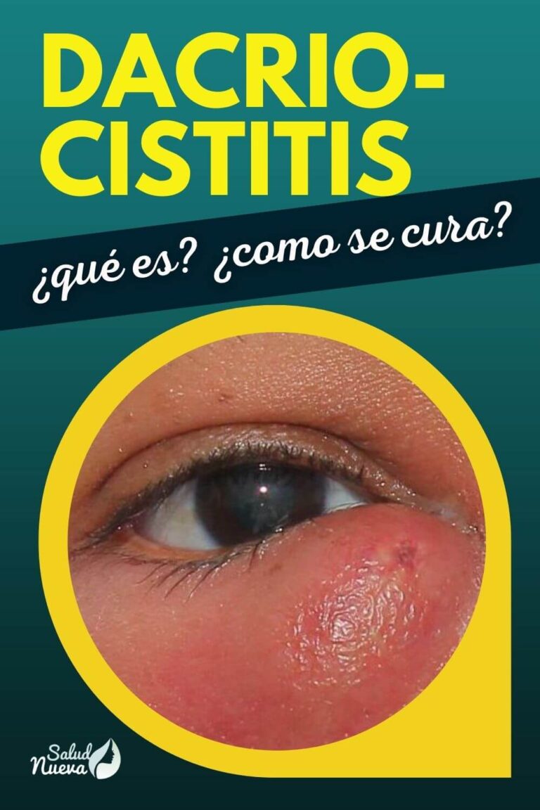 Dacriocistitis causas síntomas y tratamiento
